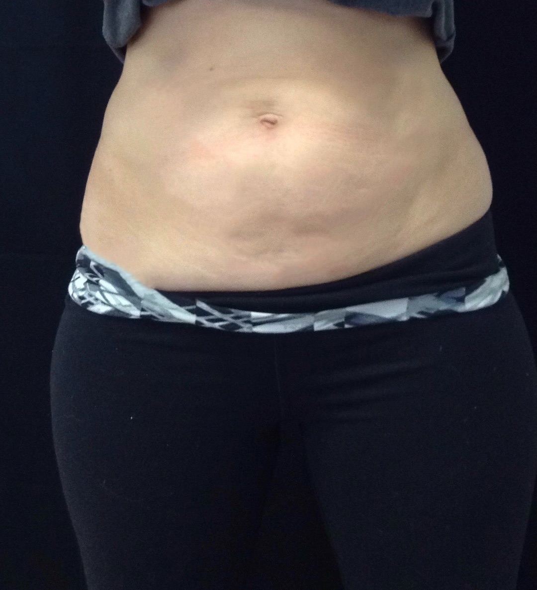 CoolSculpting in Gainesville, FL - Freeze Fat | Pure Aesthetics