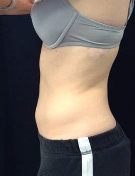 CoolSculpting in Gainesville, FL - Freeze Fat | Pure Aesthetics