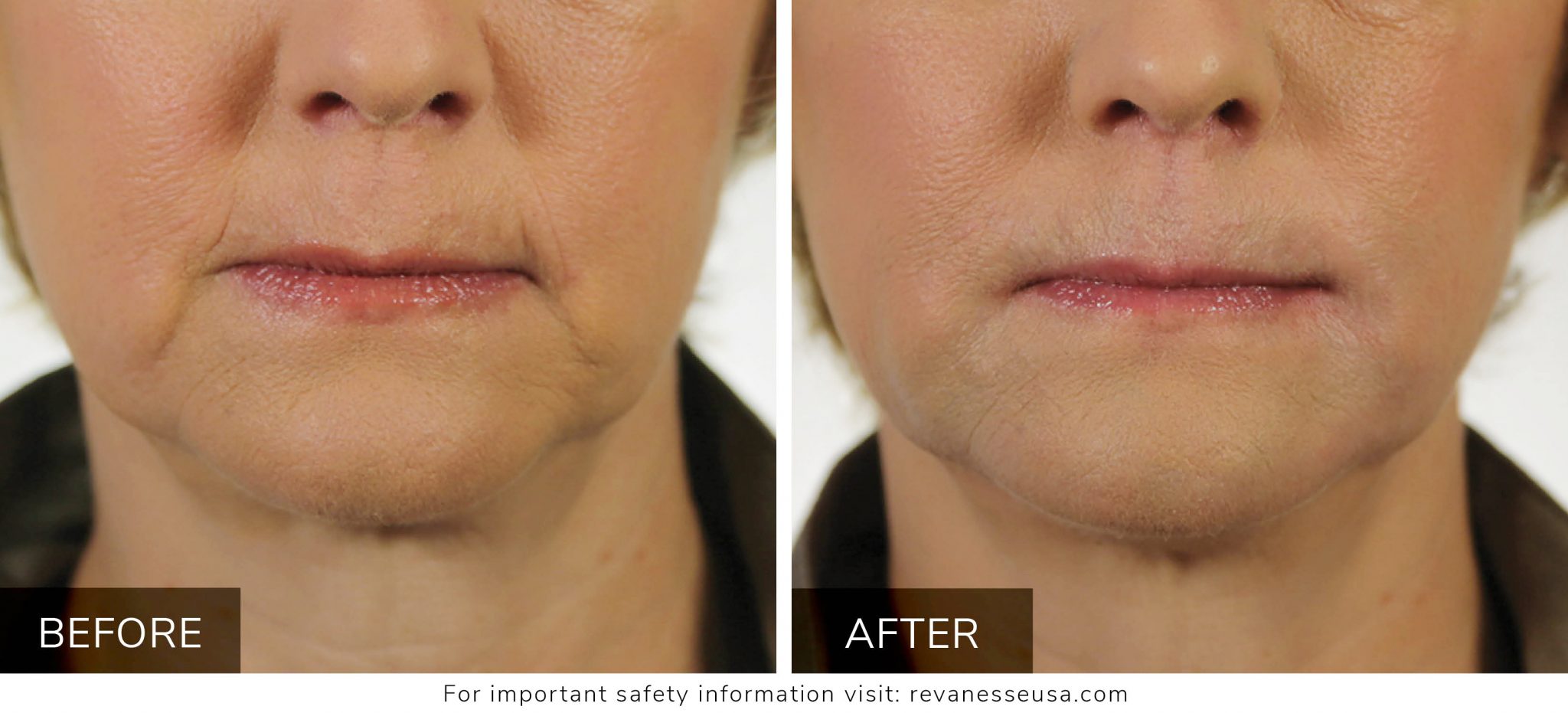 Revanesse Versa Filler - Pure Aesthetics