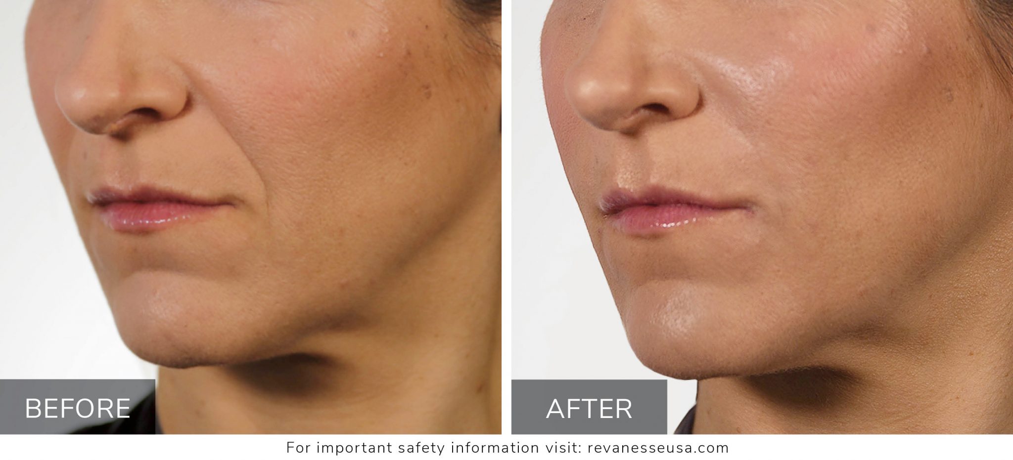 Revanesse Versa Filler - Pure Aesthetics