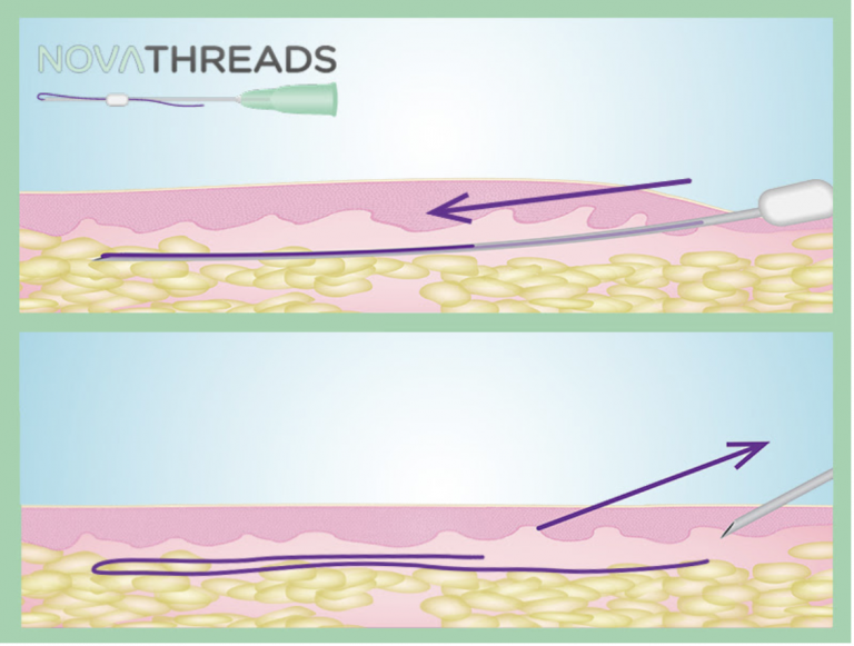 PDO Threads in Gainesville, FL - Pure Aesthetics