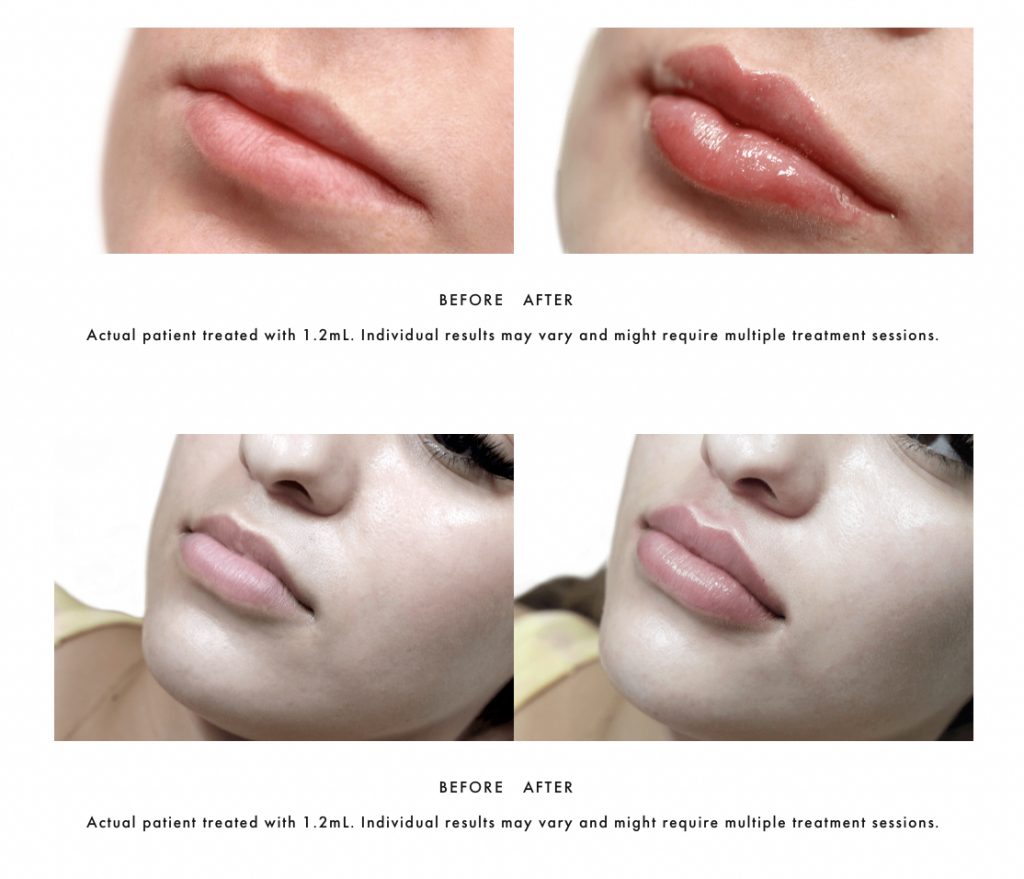 Revanesse LIPS+ - Pure Aesthetics
