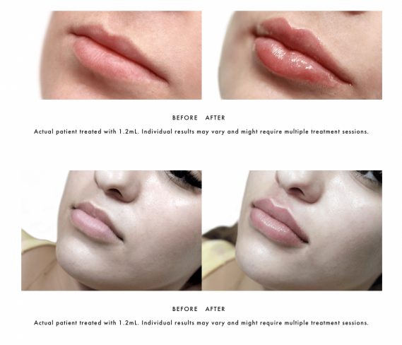 Revanesse LIPS+ - Pure Aesthetics