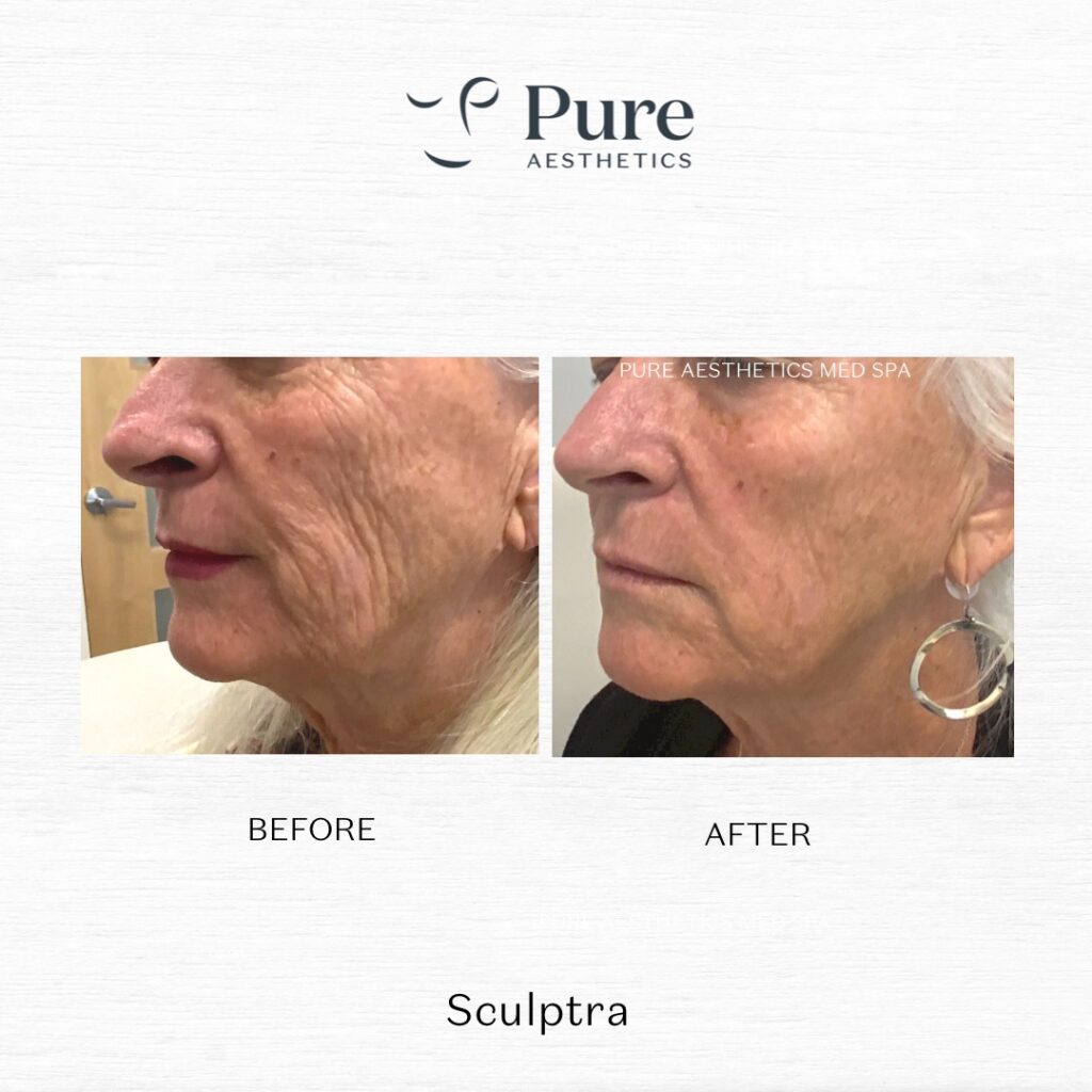 Thinking About Sculptra? Here’s What to Know - Pure Aesthetics